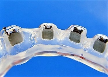 3D Indirect Bonding - Ordont Orthodontic Appliance Lab