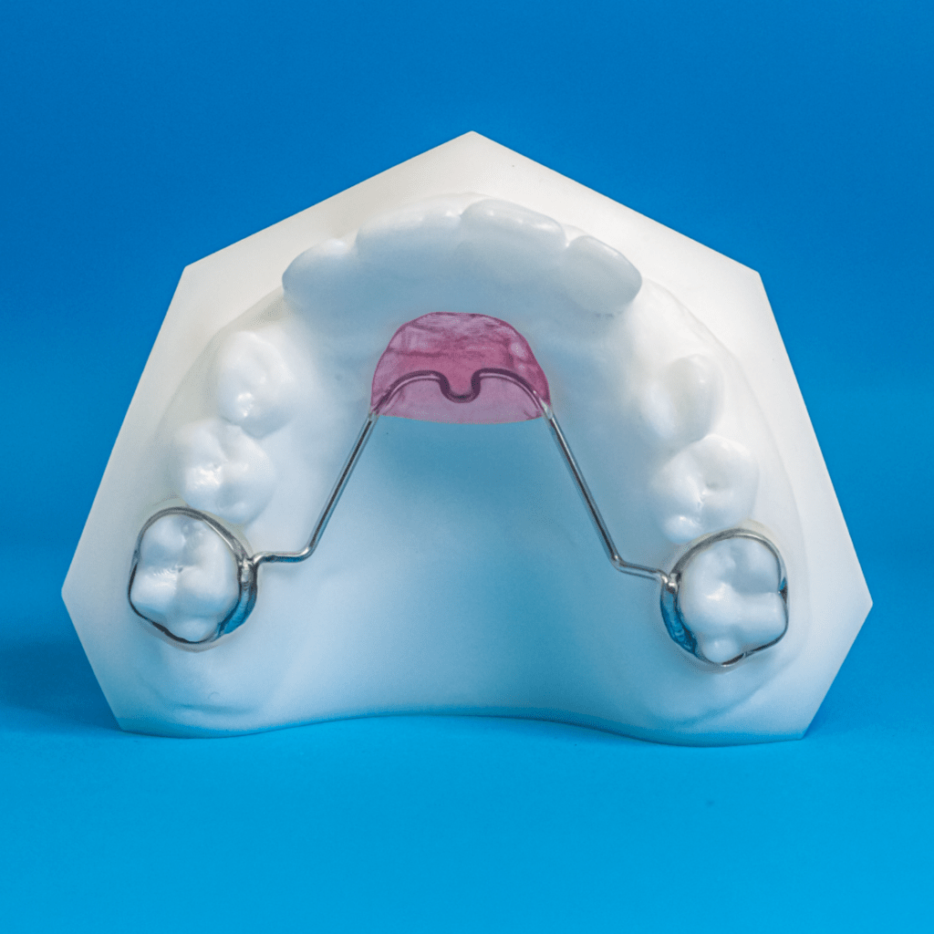 Upper Nance Appliance - Ordont Orthodontic Appliance Lab